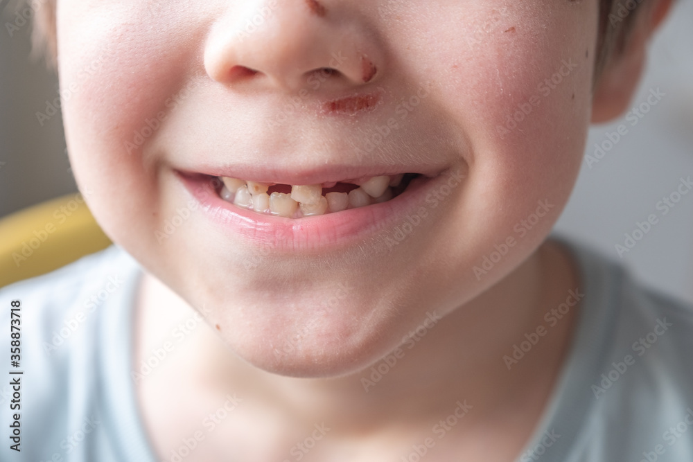 Toothless kid smiling. Little boy Show Broken teeth Stock Photo | Adobe ...