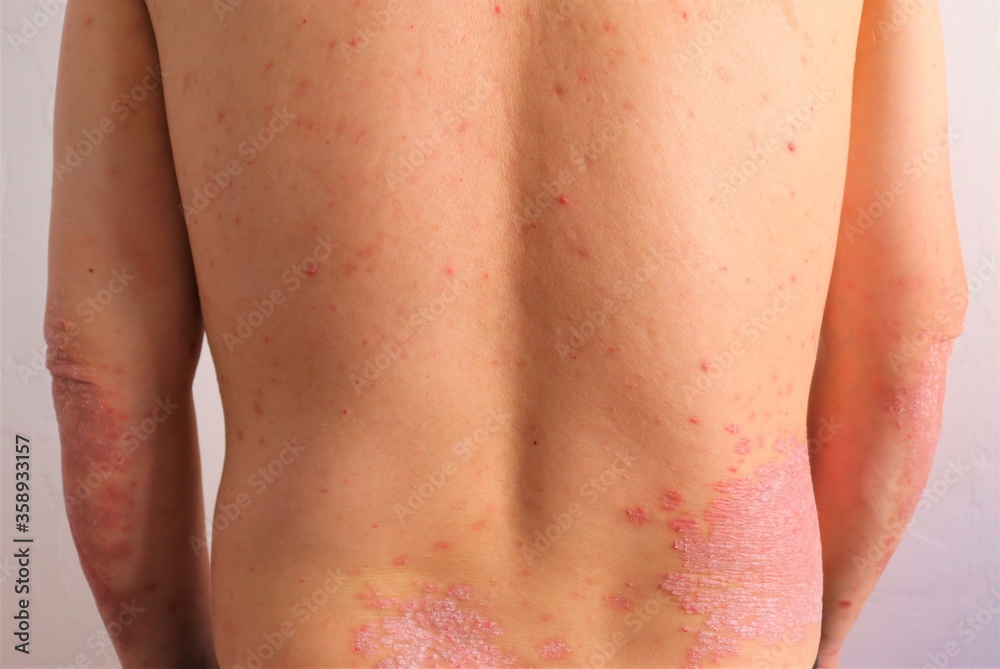 psoriasis, chronic non-infectious skin disease, autoimmune disease, red ...