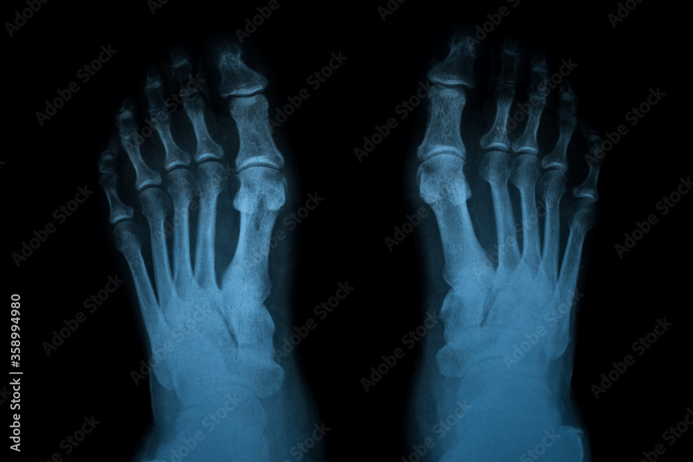 Film X-ray of Rheumatoid arthritis leg shows joint space narrowing of ...