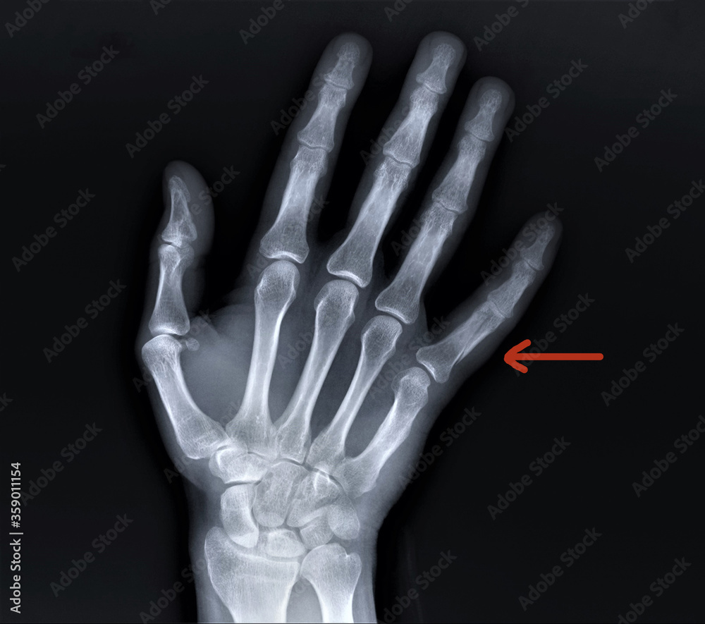 radiography of the hand bones with a fracture of the proximal phalanx ...