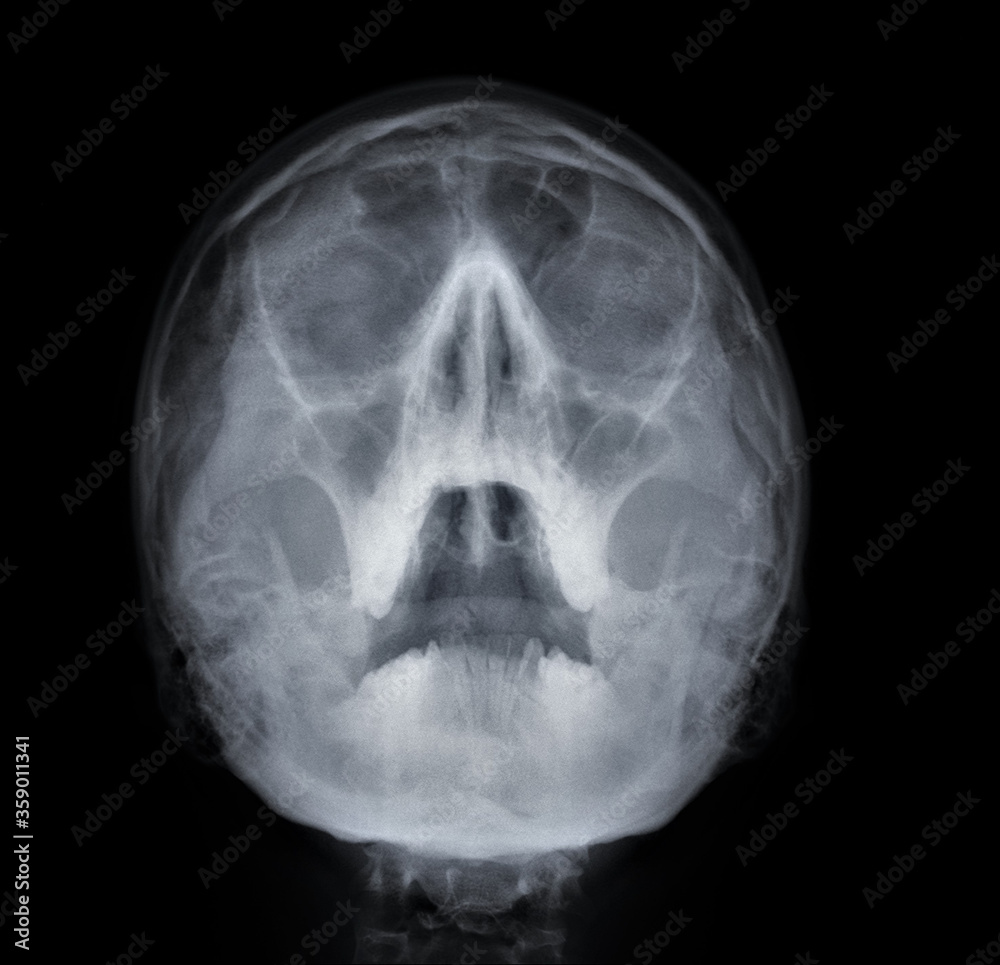 radiography of the paranasal sinuses and bones of the facial skeleton ...