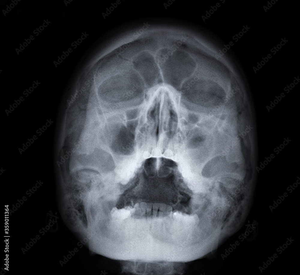 radiography of the paranasal sinuses and bones of the facial skeleton ...