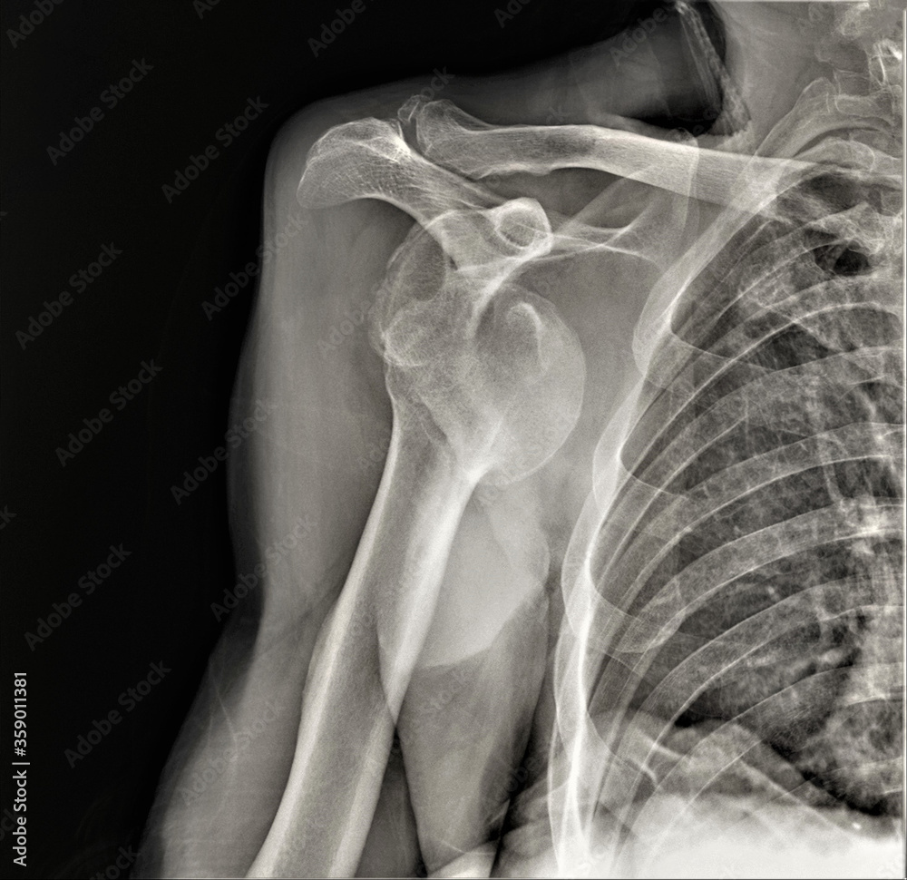 the x ray shows a dislocation of the humerus head Stock Photo | Adobe Stock