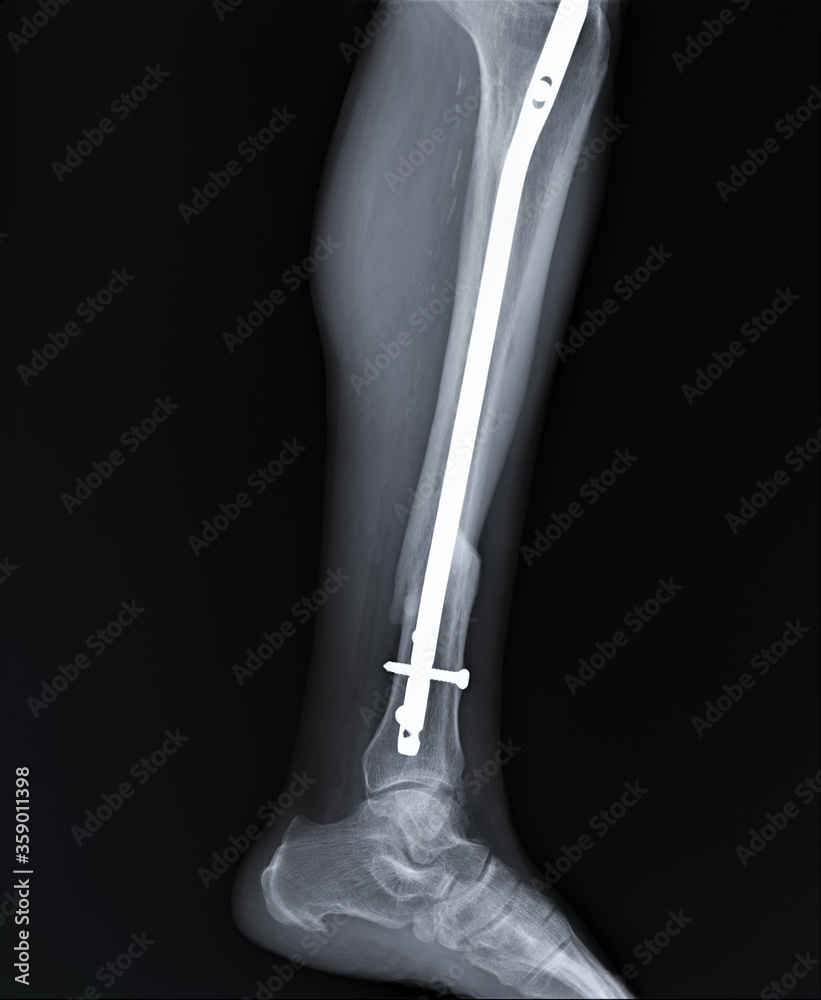 radiography with an unconsolidated fracture of the tibia of the fixed ...