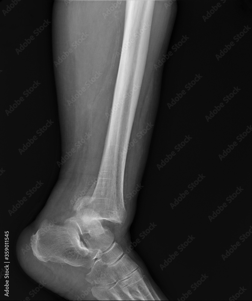 x-ray of an ankle fracture with a dislocated foot Stock Photo | Adobe Stock