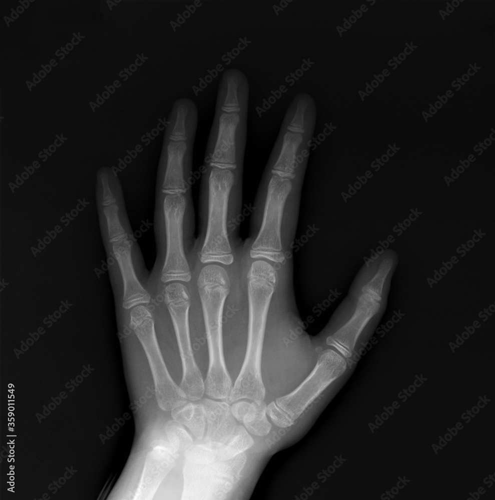 radiography of the hand bones without pathology Stock Photo | Adobe Stock