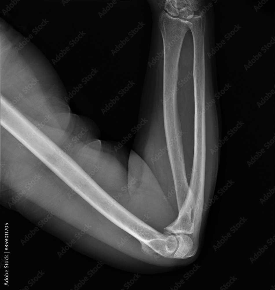x-ray of the normal elbow joint.medical diagnostics Stock Photo | Adobe ...