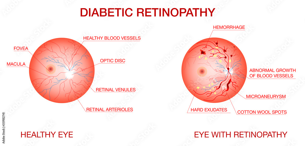 Anatomy of normal eye and Diabetic retinopathy.Diagram of the eye ...