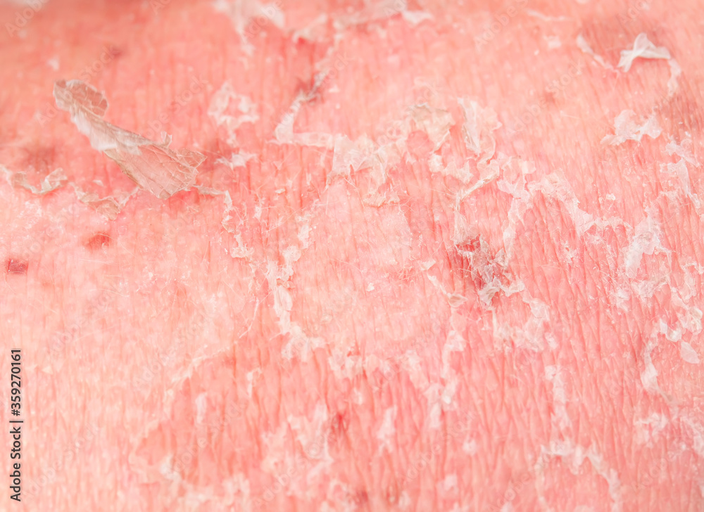 Texture Of Irritated Reddened Skin With Flaking Scales Of Dead Old