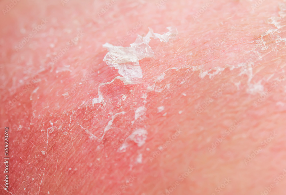 background with the texture of irritated reddened skin with flaking ...