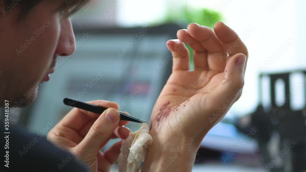 Man cleaning a bleeding wound under the skin after the accident ...