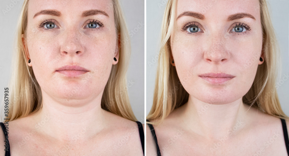 Second chin lift in women. Photos before and after plastic surgery ...