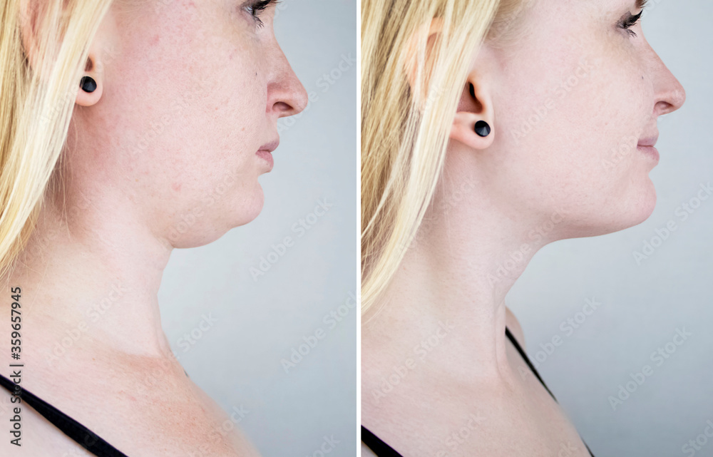 Second chin lift in women. Photos before and after plastic surgery ...