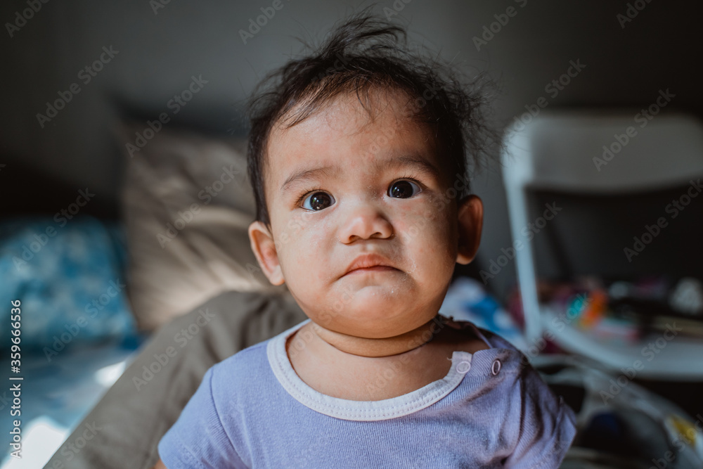 portrait of asian baby with skin rashes from allergies or irritation ...