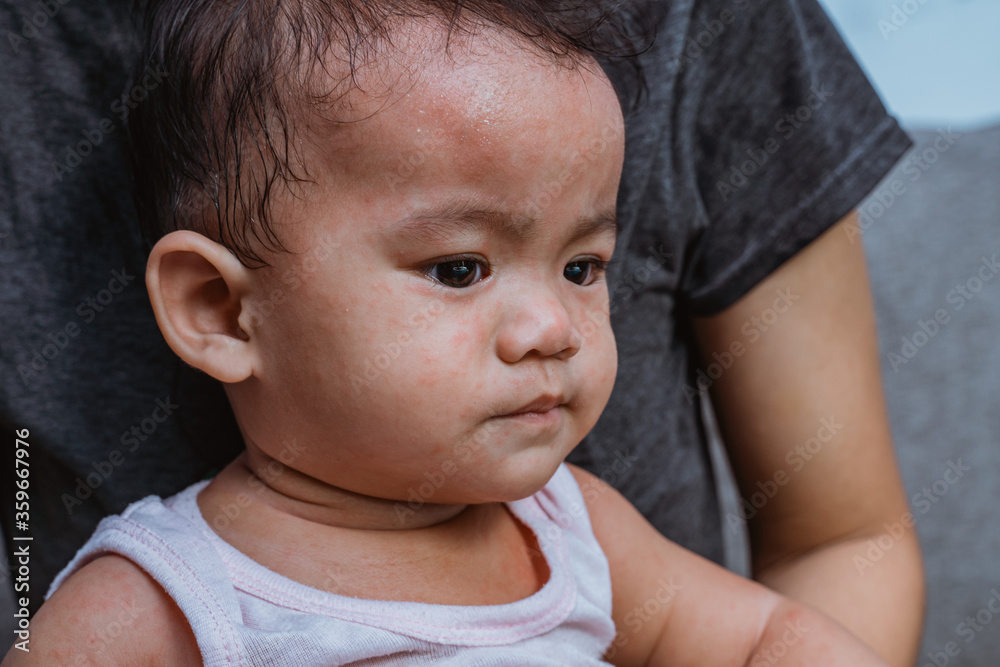 portrait of asian baby with skin rashes from allergies or irritation ...
