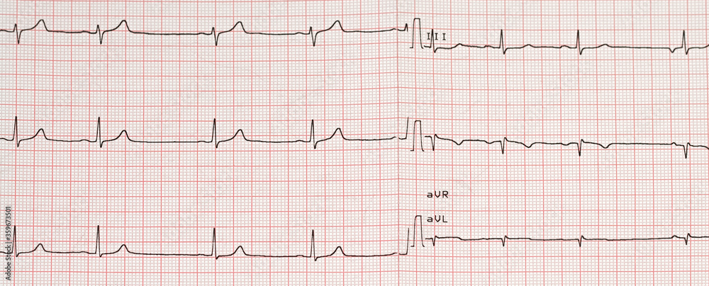 Electrocardiogram example of a normal 12-lead sinus rhythm Stock Photo ...