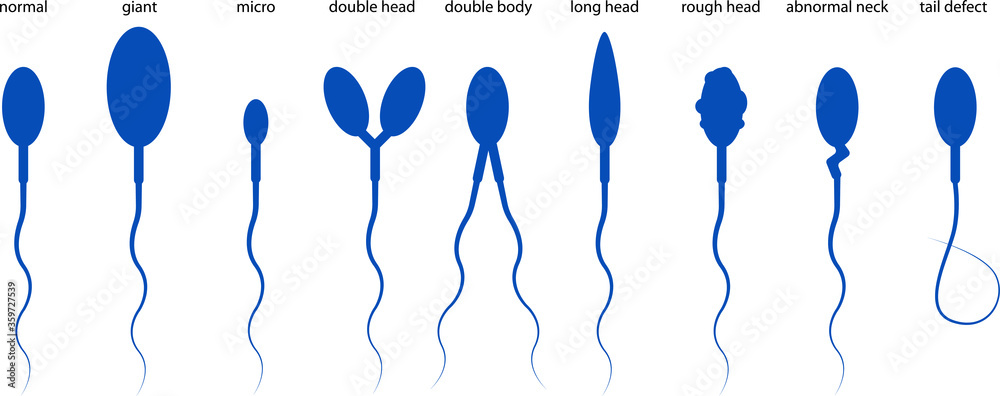 Poster Sperm morphology. Normal and abnormal sperm. – Muurposter ...