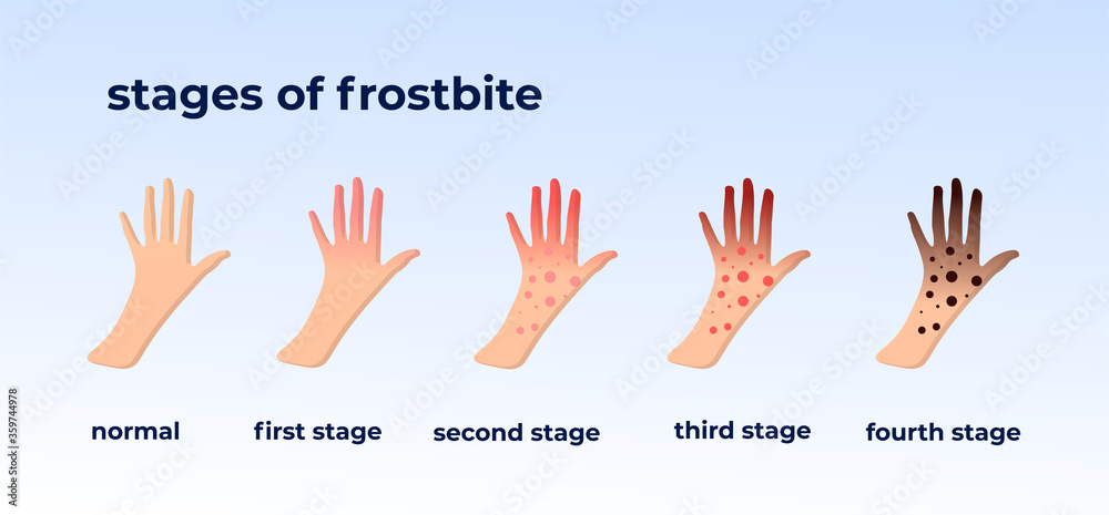 Frostbite stages. Hypothermia in cold season. Medical infographic. Blue ...