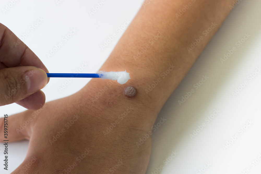 Common wart ( Verruca vulgaris ) on child´s arm beeing treatment ...