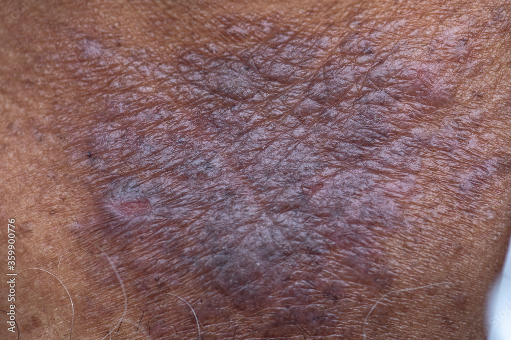 A physical of Atopic dermatitis (AD), also known as atopic eczema, is a ...