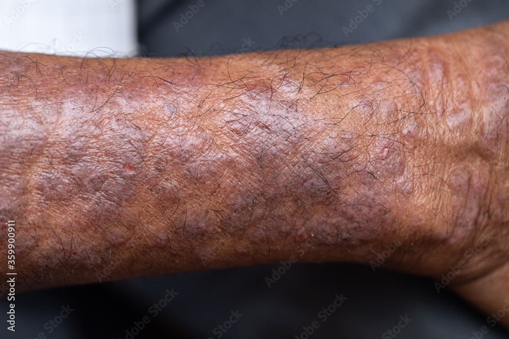 A physical of Atopic dermatitis (AD), also known as atopic eczema, is a ...