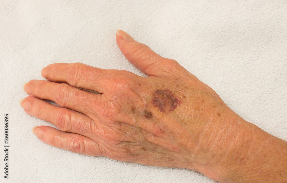 Female hand of senior showing the bruising of a slight injury. Thinning ...