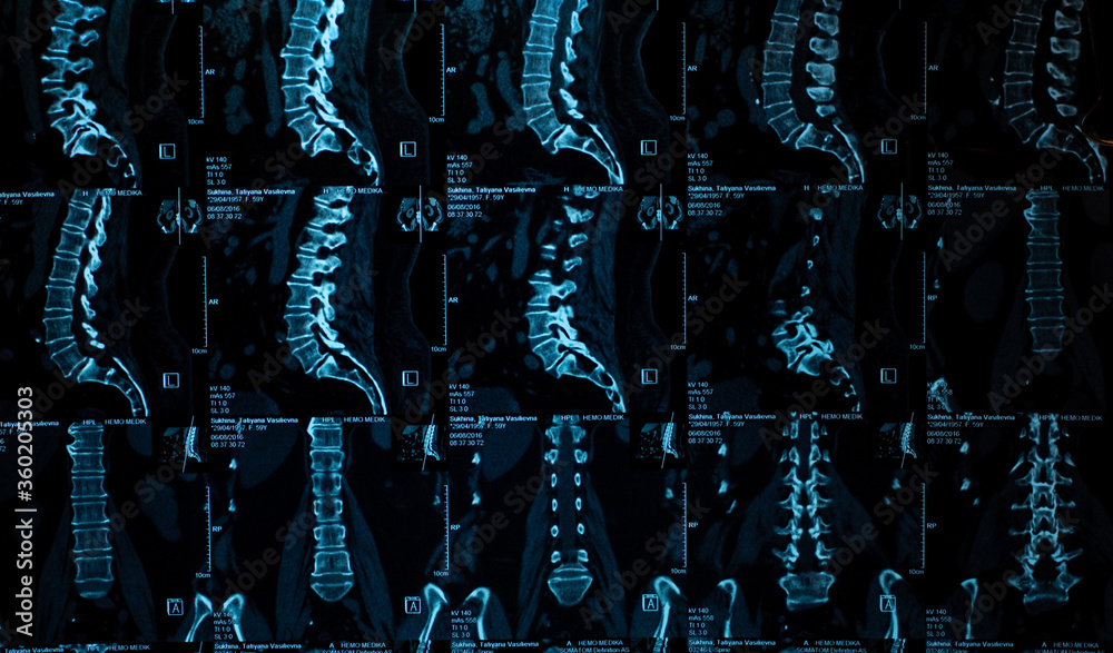 MRI scans of the lumbosacral spine. MRI shows degenerative changes in ...