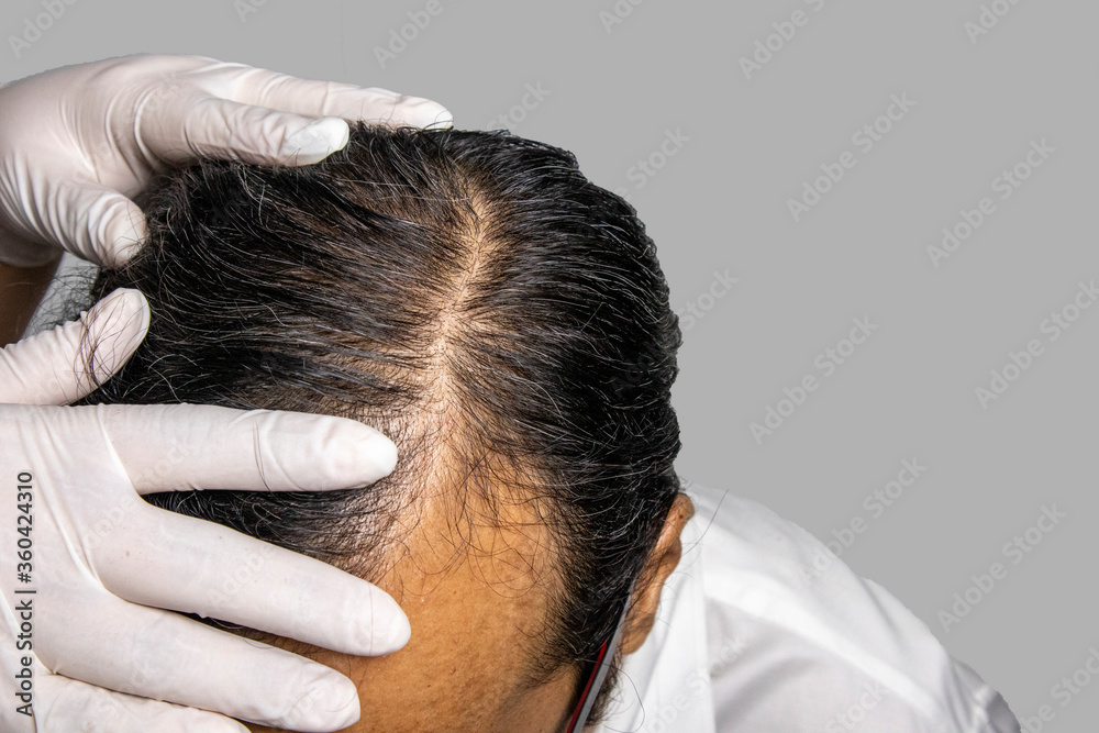 Man visit dermatologist for his hair fall problem. Checking and ...
