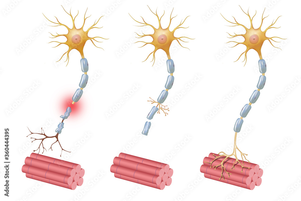 Neuroregeneration refers to the regrowth or repair of nervous tissues ...