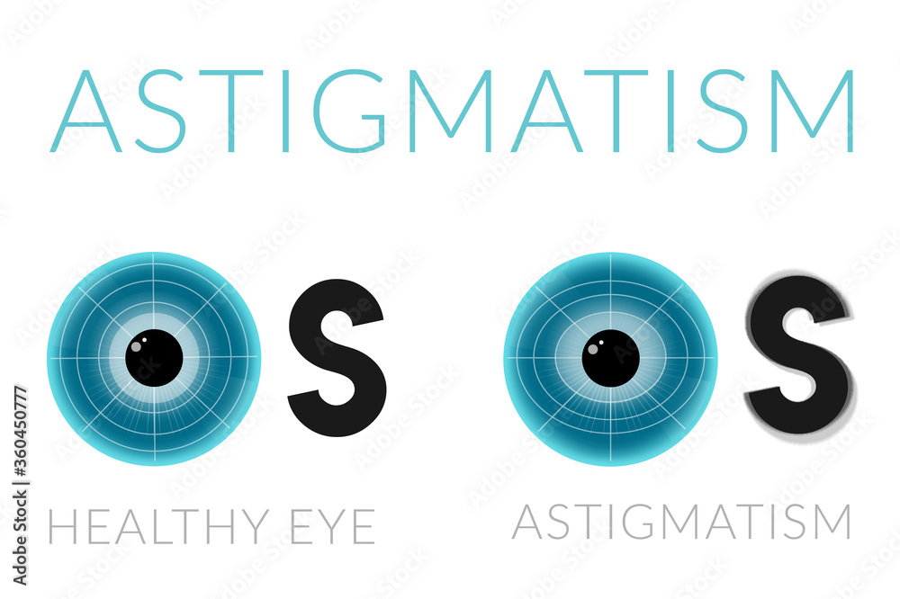 Healthy eye and astigmatism comparisons. Medical poster about eye ...
