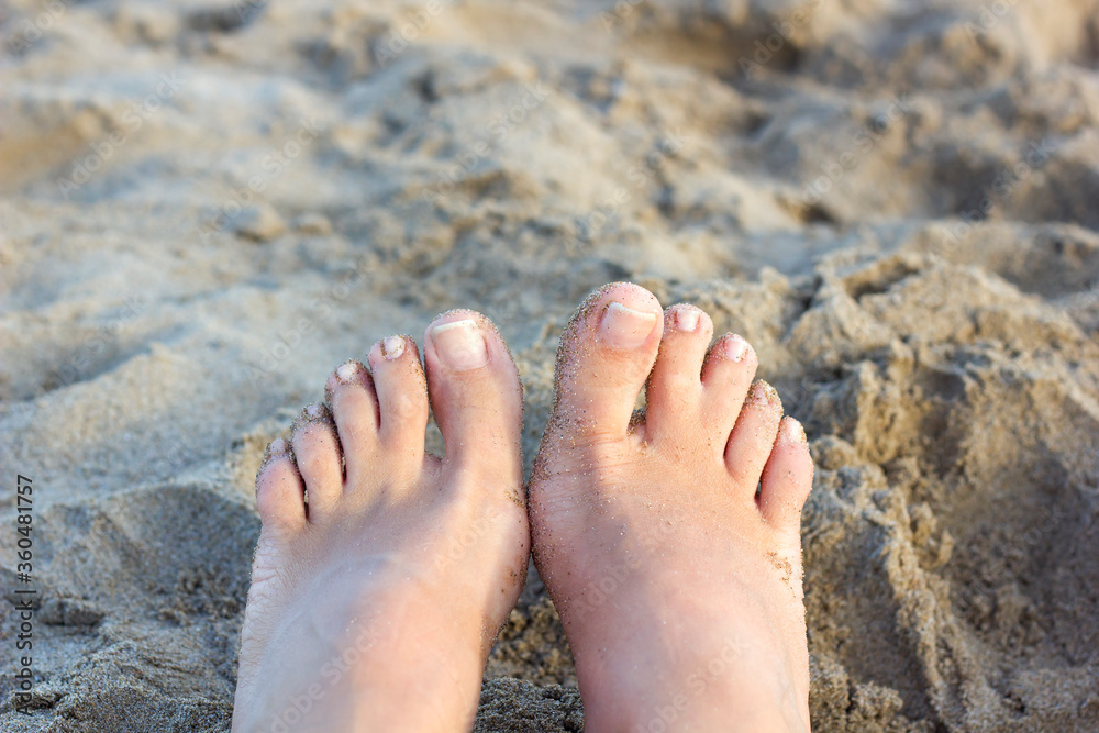 Webbed toes- birth defect. Close up of fused toes on an adult Caucasian ...