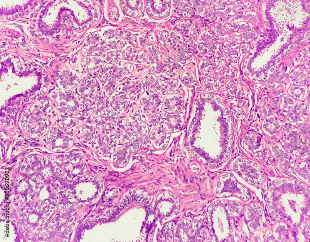 Photo of sclerosing adenosis, of breast tissue. Photo under light ...