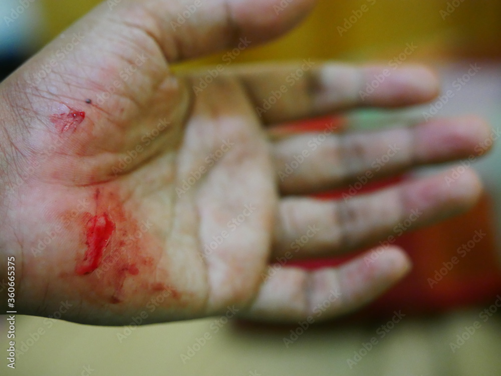 Close up hand injury, accident cut with knife, real bloody hand. Stock ...