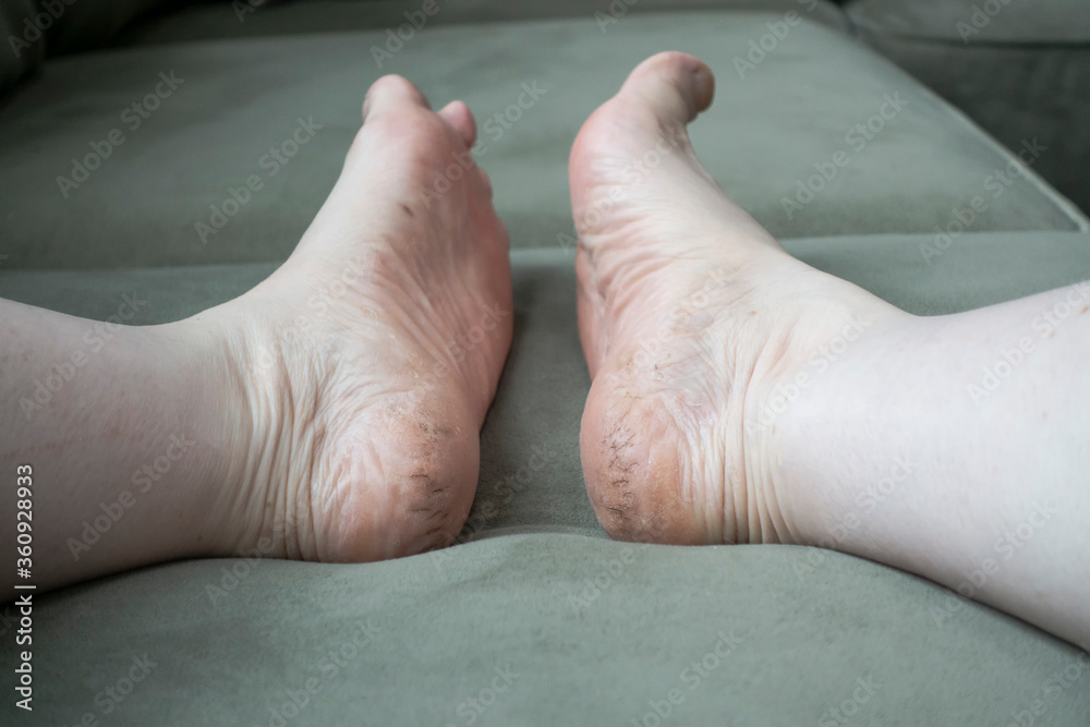 Feet with very rough and cracked heels, the cracks are deep and dirty ...