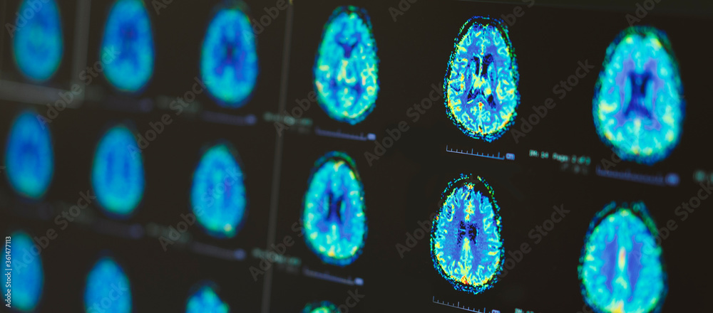The imaging of advanced MRI. MRI perfusion scan. Stock Photo | Adobe Stock