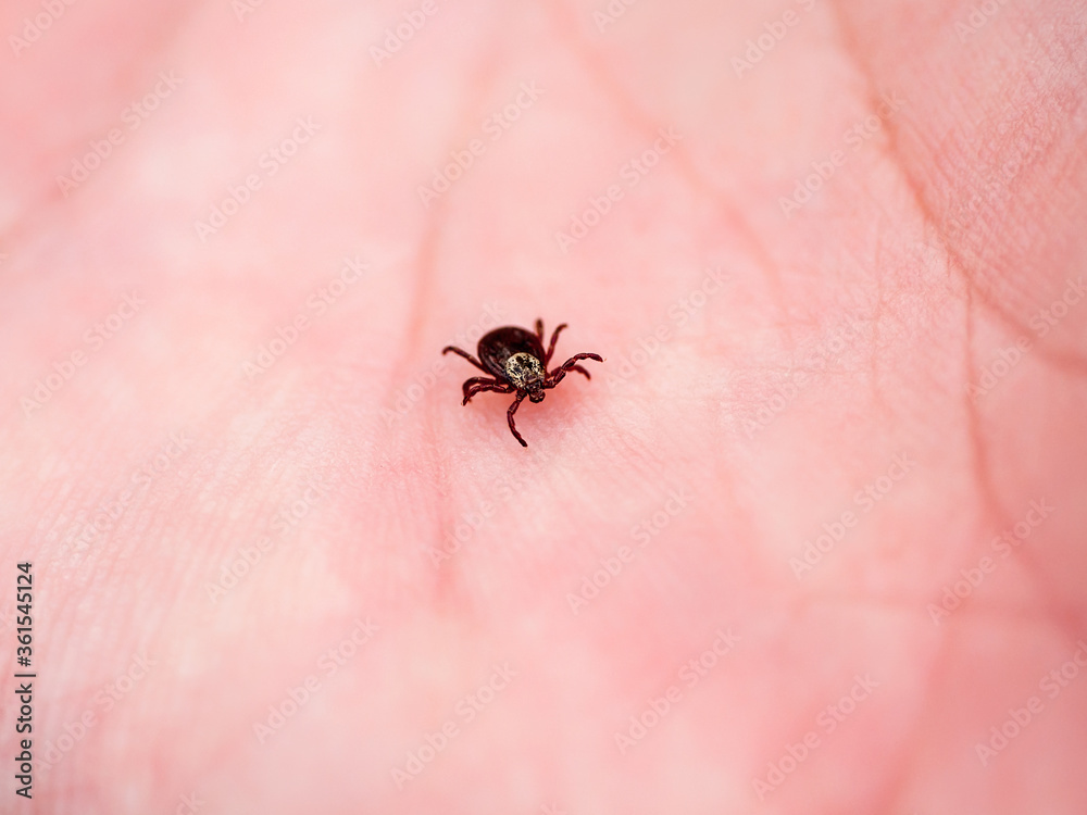 Lyme Disease Infected Tick Insect Crawling on Skin. Encephalitis Virus ...