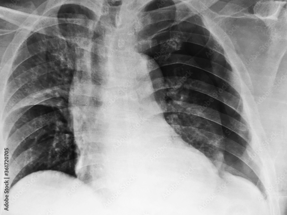chest x ray with tension Pneumothorax Stock Photo | Adobe Stock