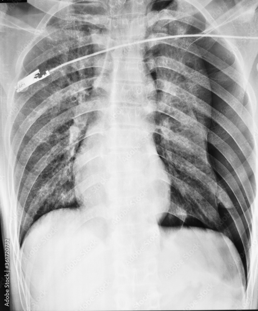 Chest Xray showing Pneumothorax Stock Photo | Adobe Stock