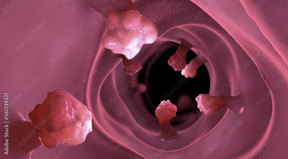Poster Close-up view of intestinal polyps and diseased intestinal ...