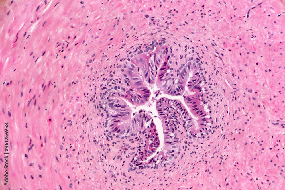 Cross section of normal vas deferens after a vasectomy. Sterilization ...