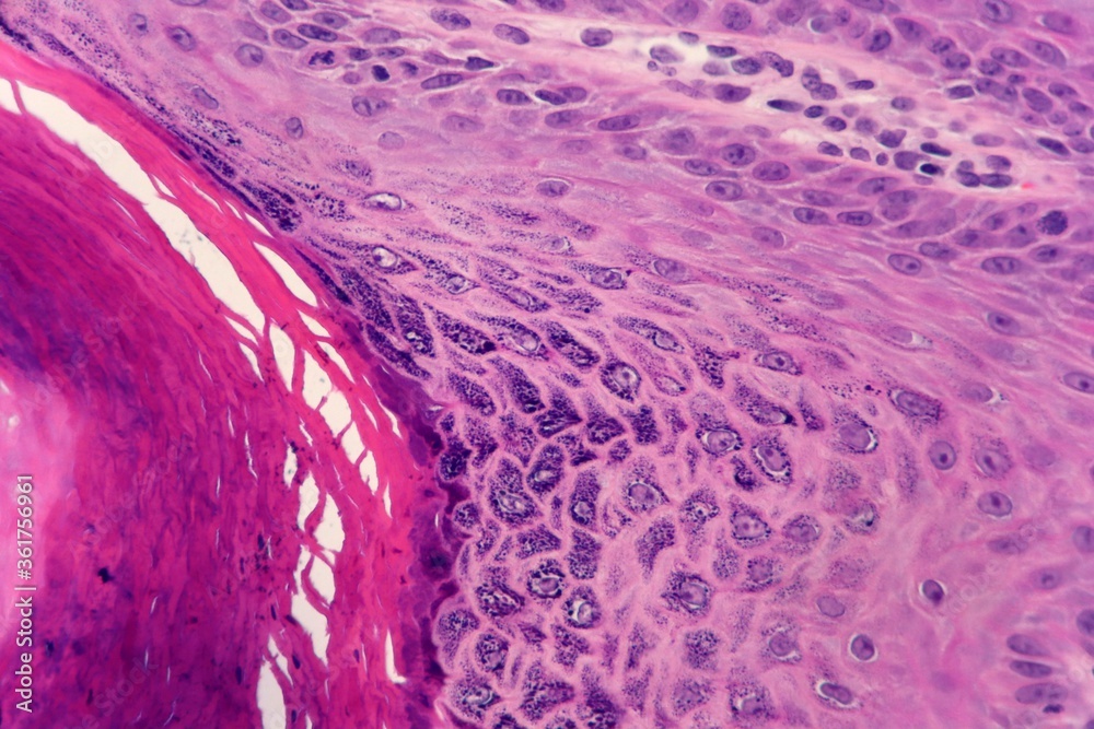 High magnification of skin cells infected with the HPV Virus. Common ...