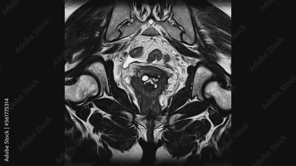 MRI of the female pelvic organs, abdominal cavity, gastrointestinal ...