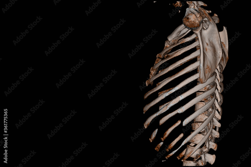 CT Scan Thoracic spine 3D finding The film shown thoracolumbar fracture ...