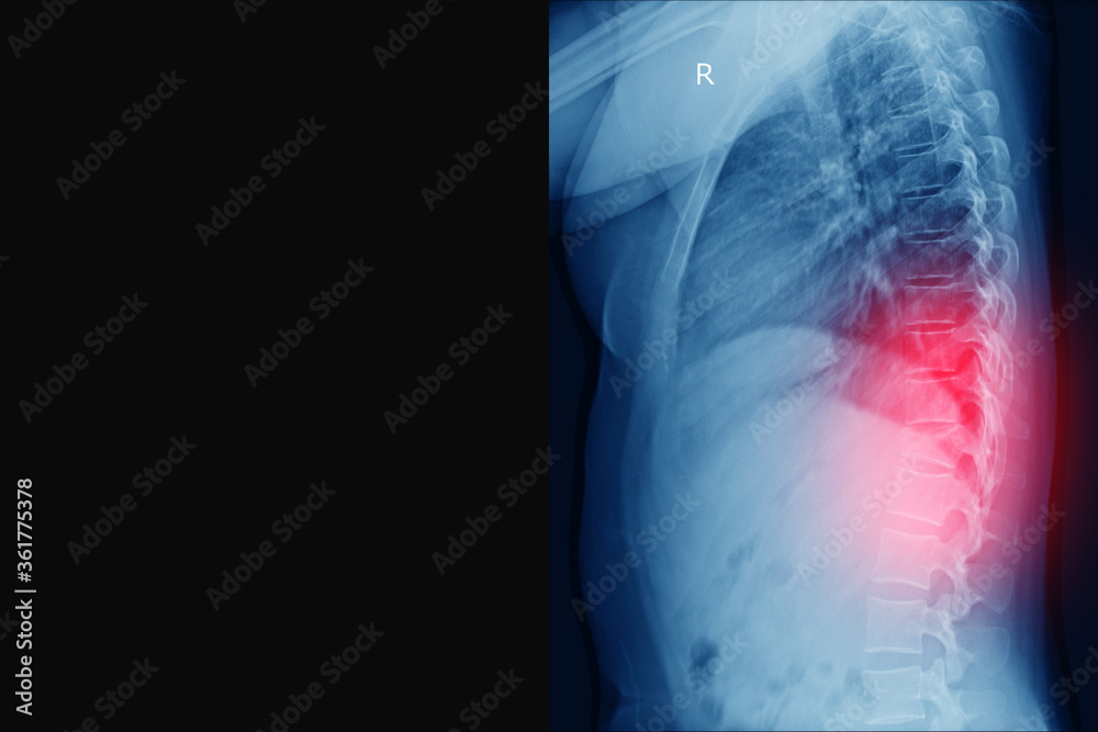 X-ray Thoracic spine fracture radiograph of thoracic and lumbar spine ...