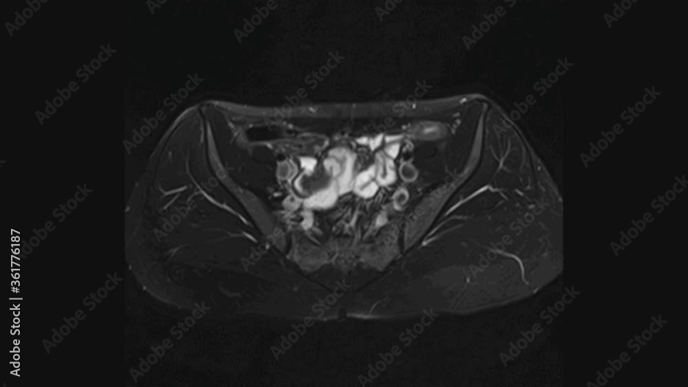 MRI of the female pelvic organs, abdominal cavity, gastrointestinal ...