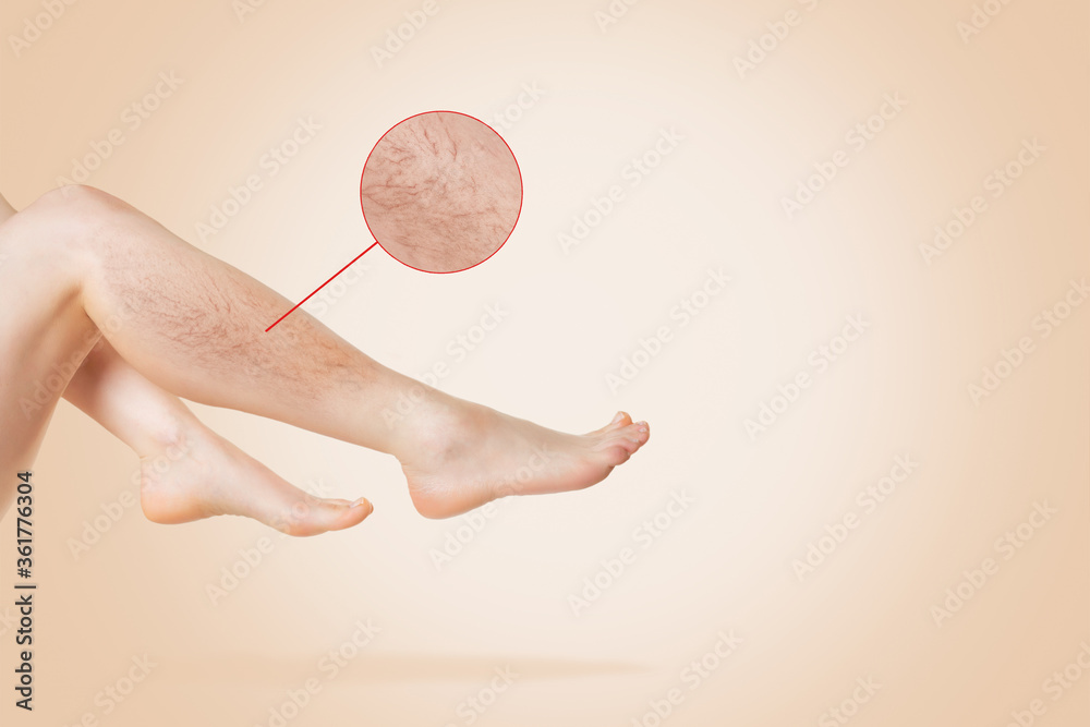 Smooth female legs, with varicose veins on the lower leg. Zoomed image ...
