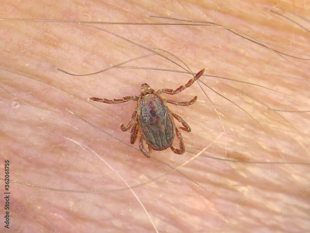 Tick on human hairy skin background. Ixodes ricinus or scapularis ...