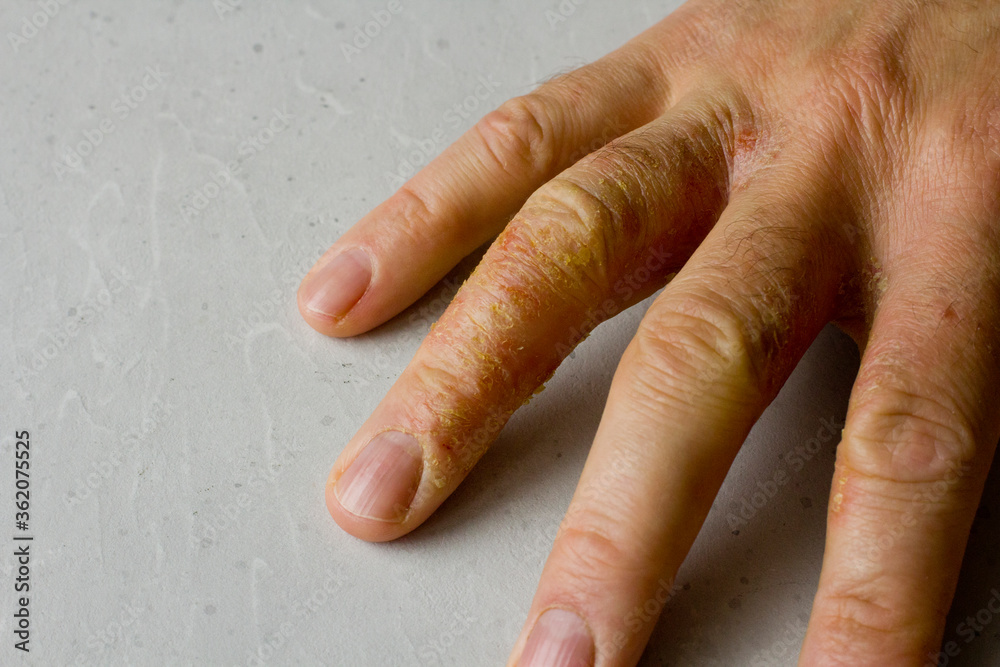 Desquamation Of Fingers