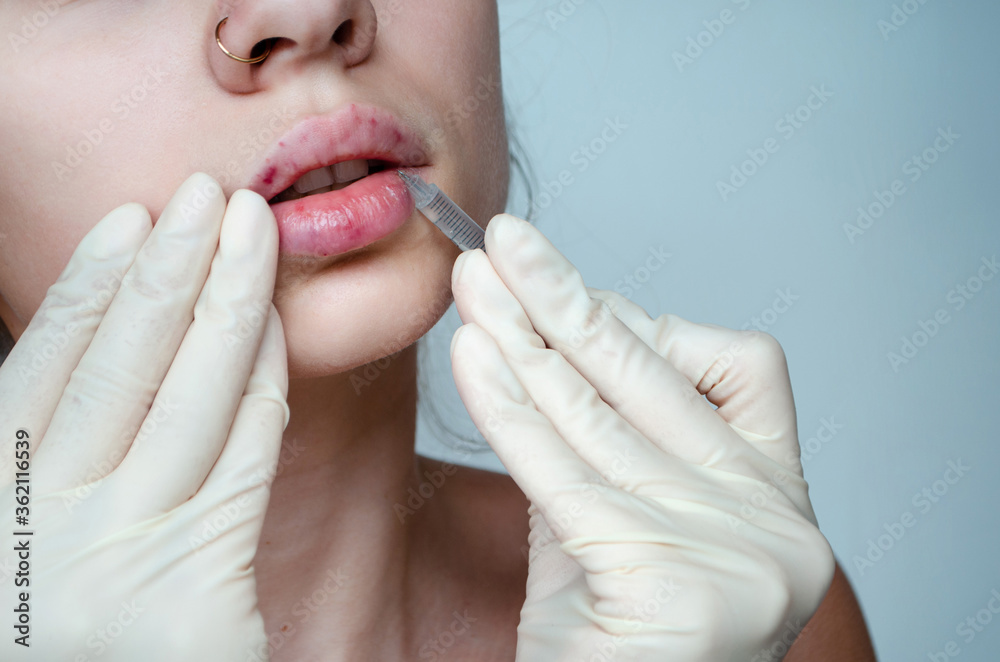Beautiful woman with a bruise on her lips after lip augmentation with ...