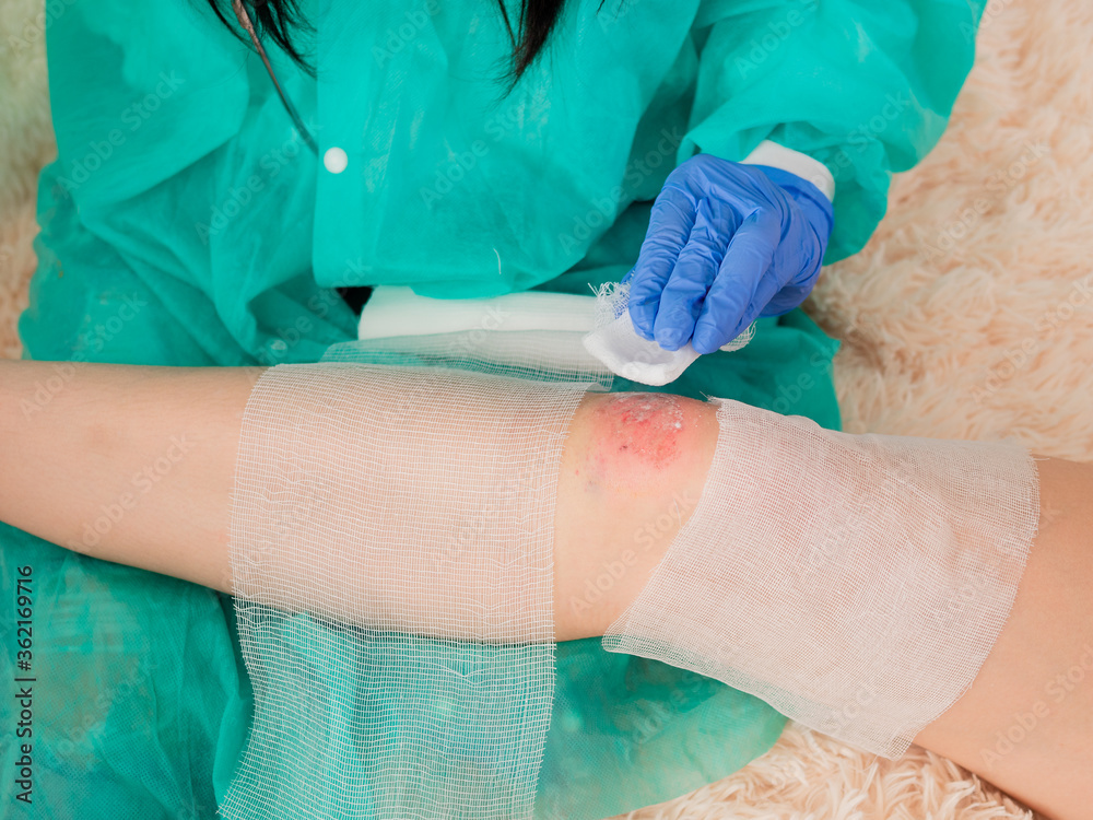 Foto de Treatment of a bleeding wound on the girl's knee with ...